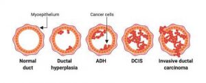 Breast Pre-Cancer Conditions | Atypical Hyperplasia Treatment